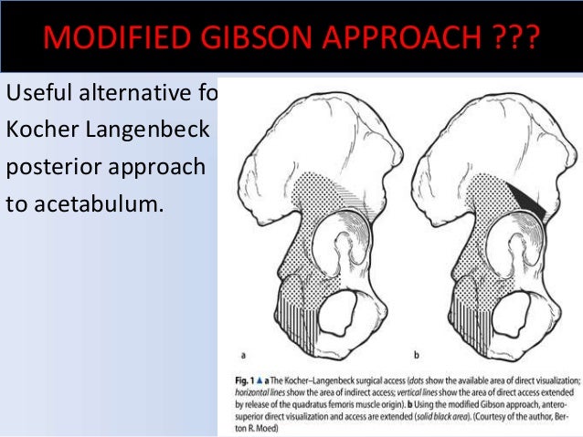 Approach to hip joint