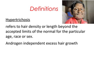 Approach to hirsutism | PPT