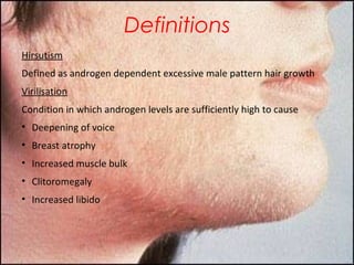 Approach to hirsutism | PPT