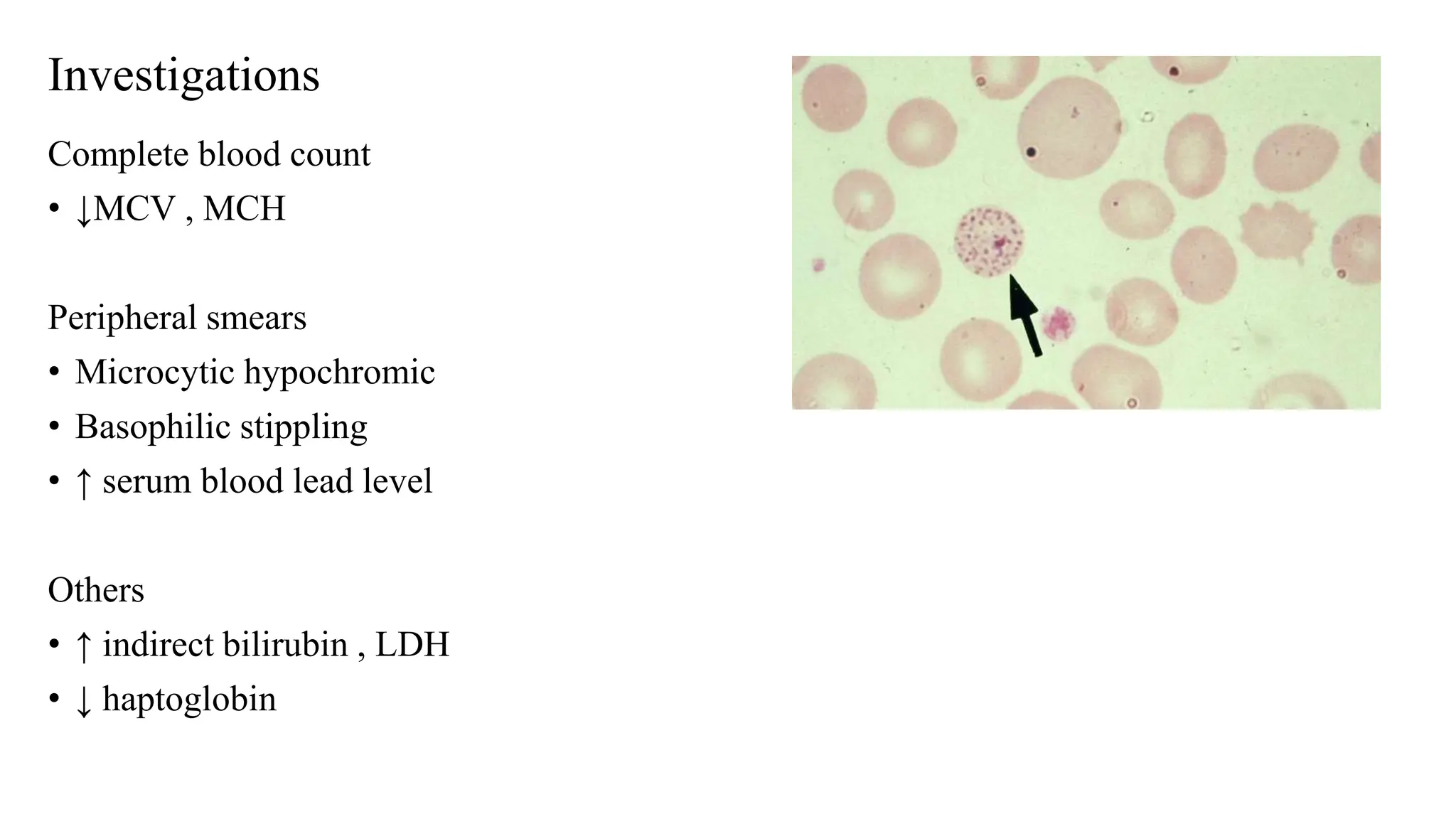 Approach to hypochromic microcytic anemias.pptx