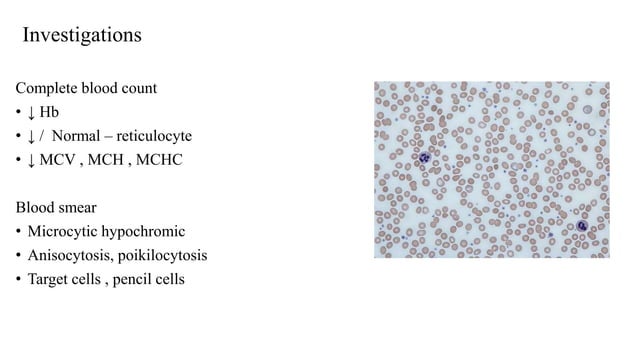 Approach to hypochromic microcytic anemias.pptx