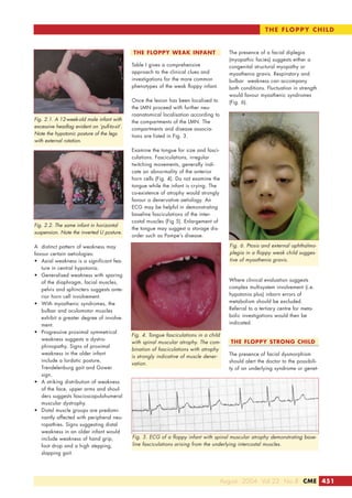Approach to hypotonia | PDF