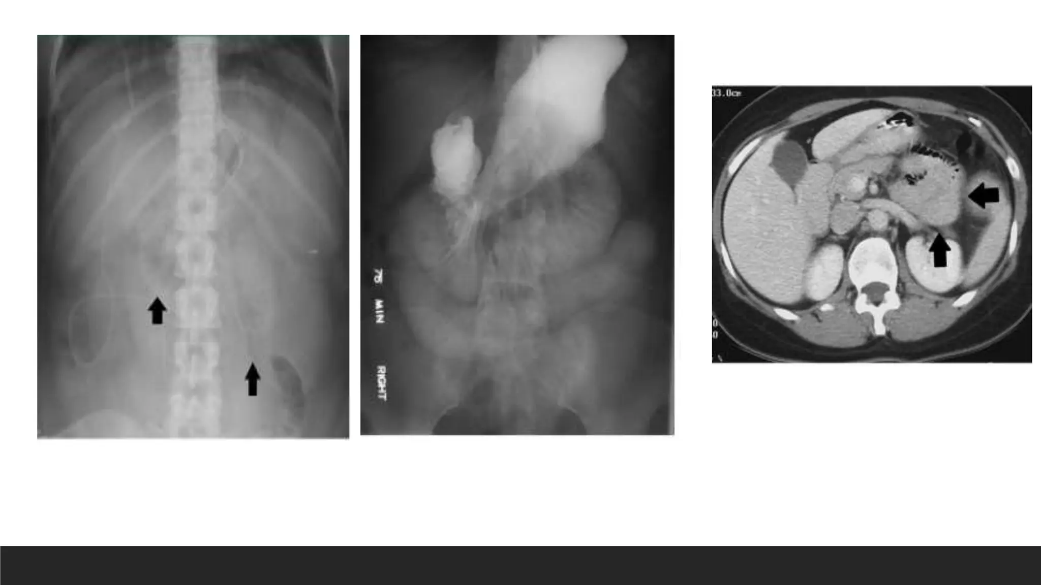 Approach to intestinal obstructions.pptx