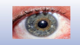Approach to Irregular Astigmatism ophthalmology | PPTX