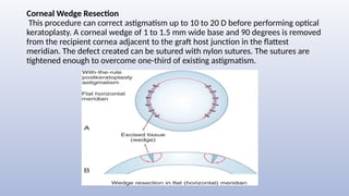 Approach to Irregular Astigmatism ophthalmology | PPTX