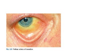 Approach to jaundice based on Harrison's | PPTX