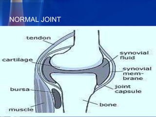 Approach to joint pain | PPTX