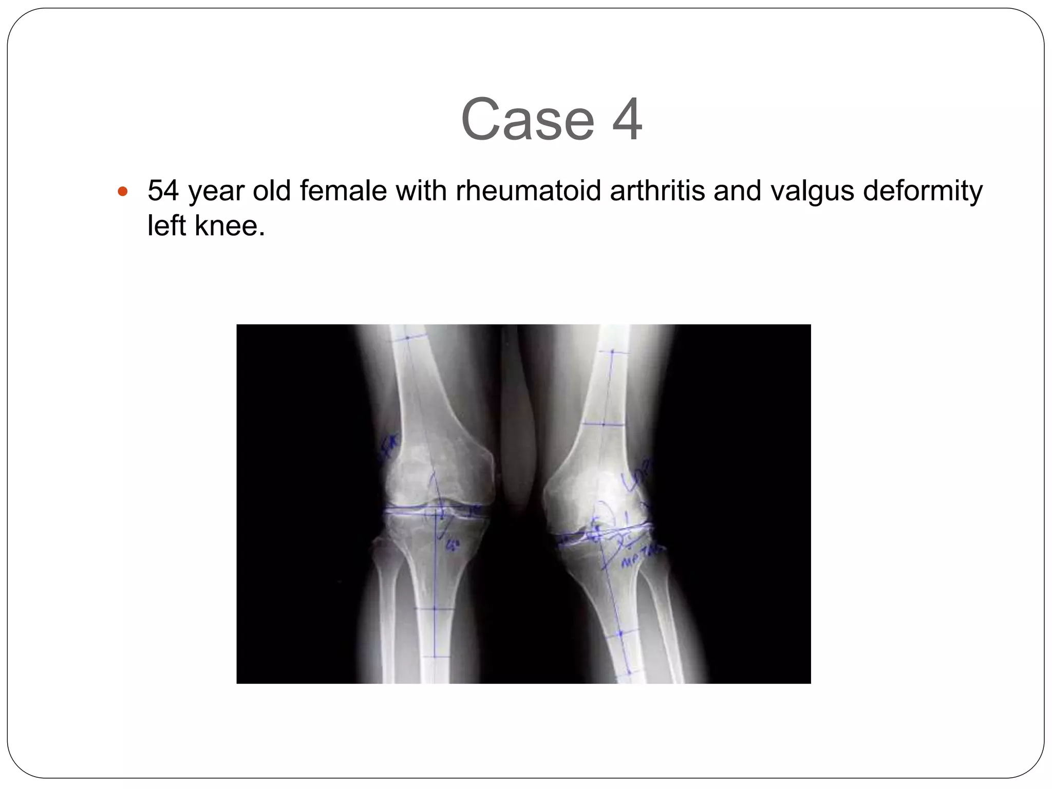 Approach to Knee in Varus, Valgus and Flexion Deformity.pptx