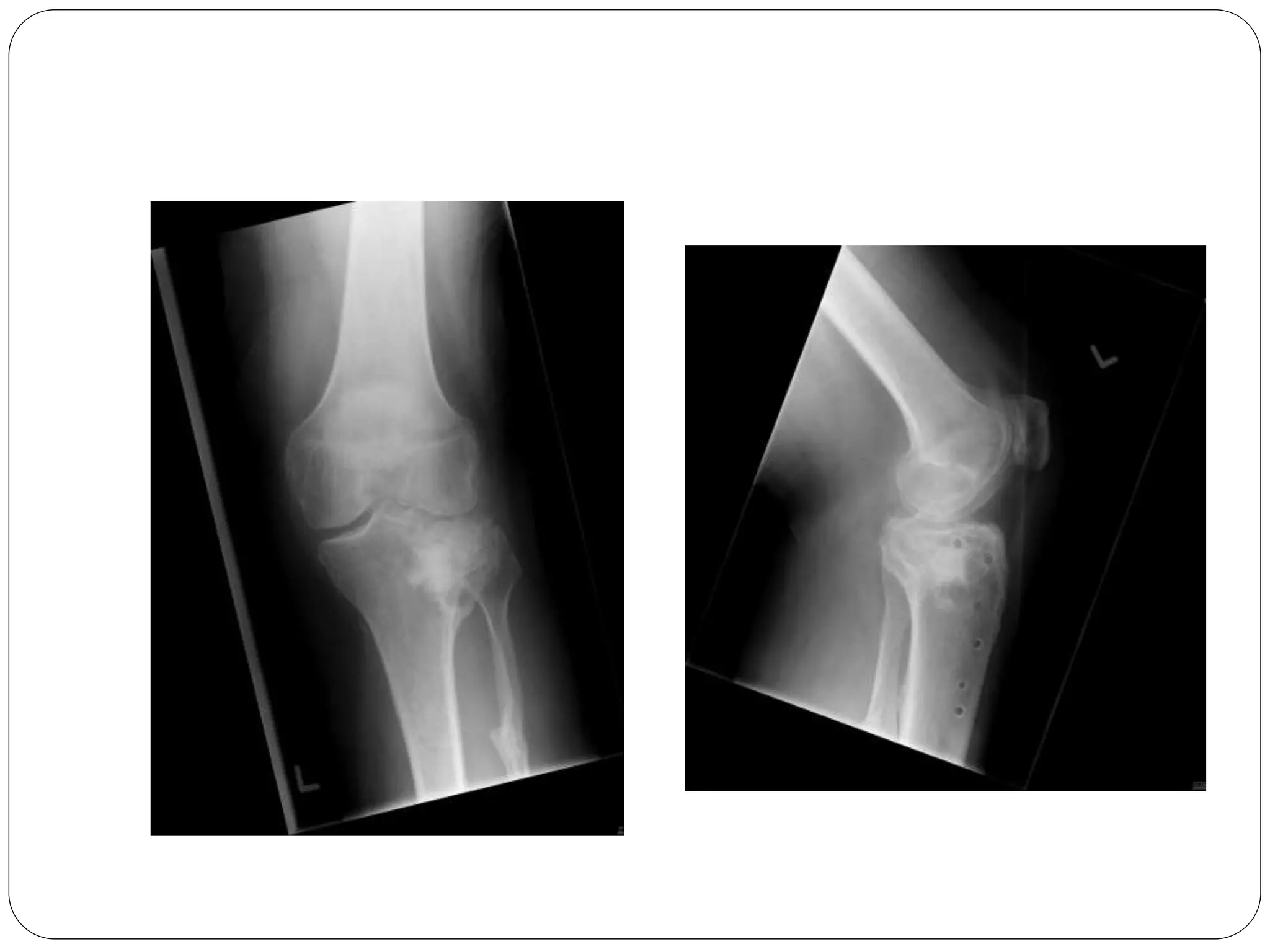 Approach to Knee in Varus, Valgus and Flexion Deformity.pptx