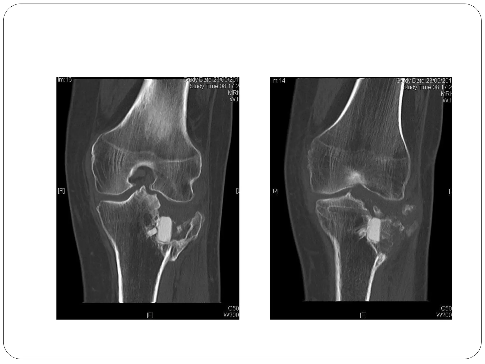 Approach to Knee in Varus, Valgus and Flexion Deformity.pptx