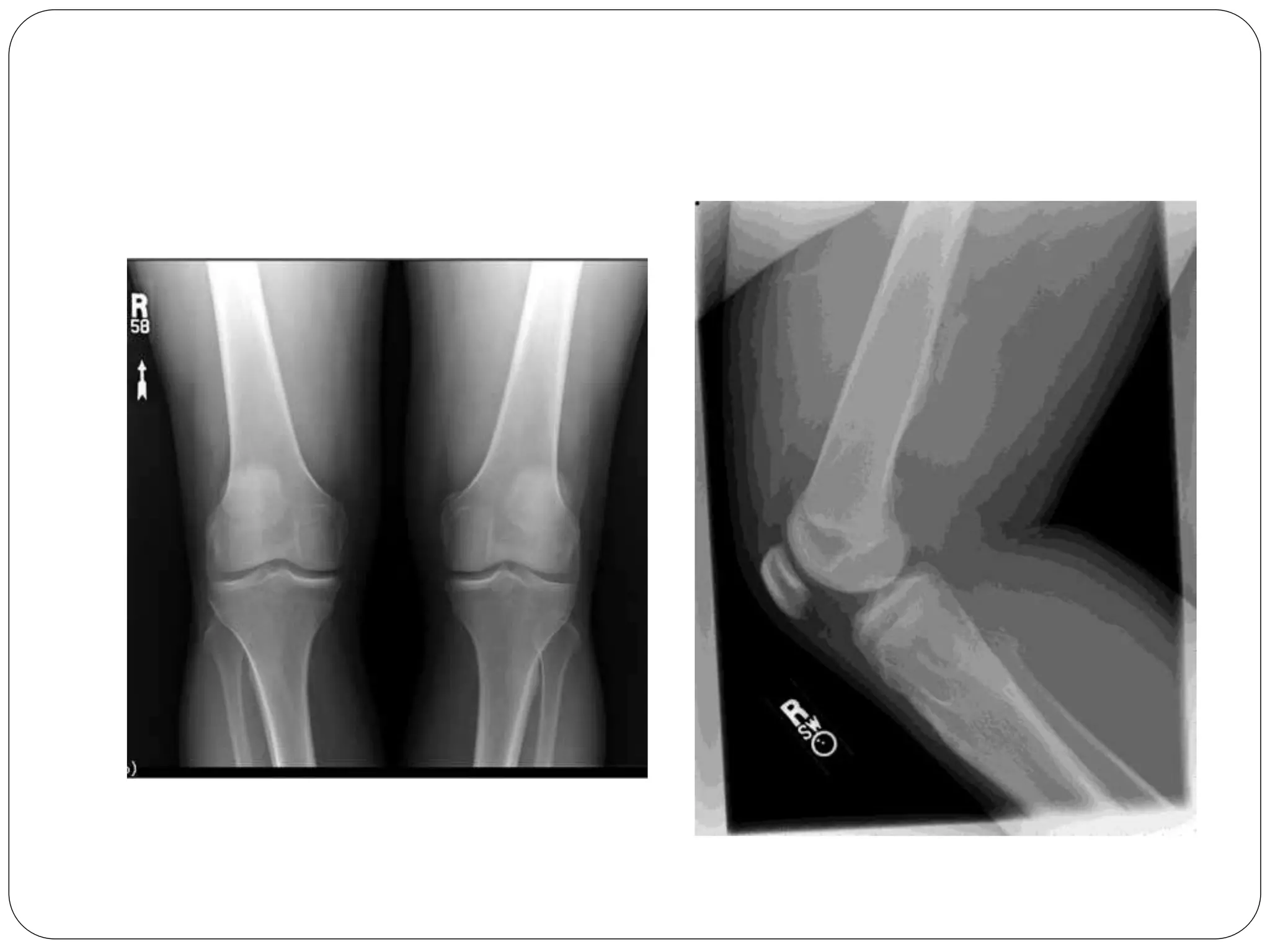 Approach to Knee in Varus, Valgus and Flexion Deformity.pptx