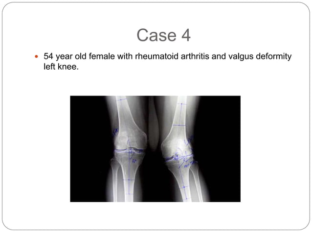 Approach to Knee in Varus, Valgus and Flexion Deformity.pptx