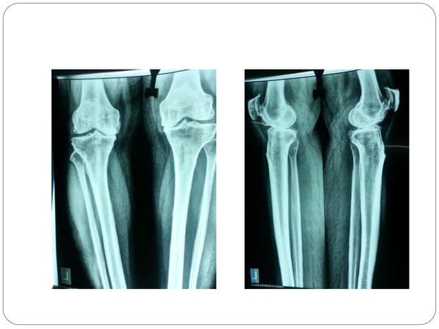 Approach to Knee in Varus, Valgus and Flexion Deformity.pptx