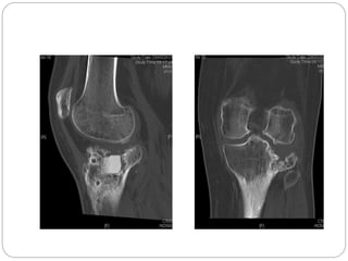Approach to Knee in Varus, Valgus and Flexion Deformity.pptx