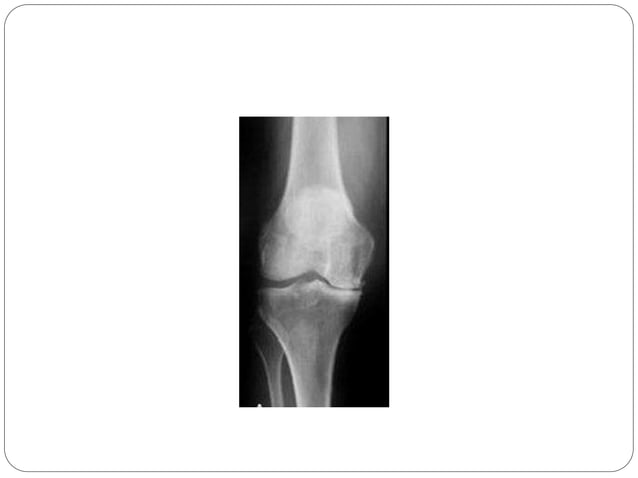 Approach to Knee in Varus, Valgus and Flexion Deformity.pptx