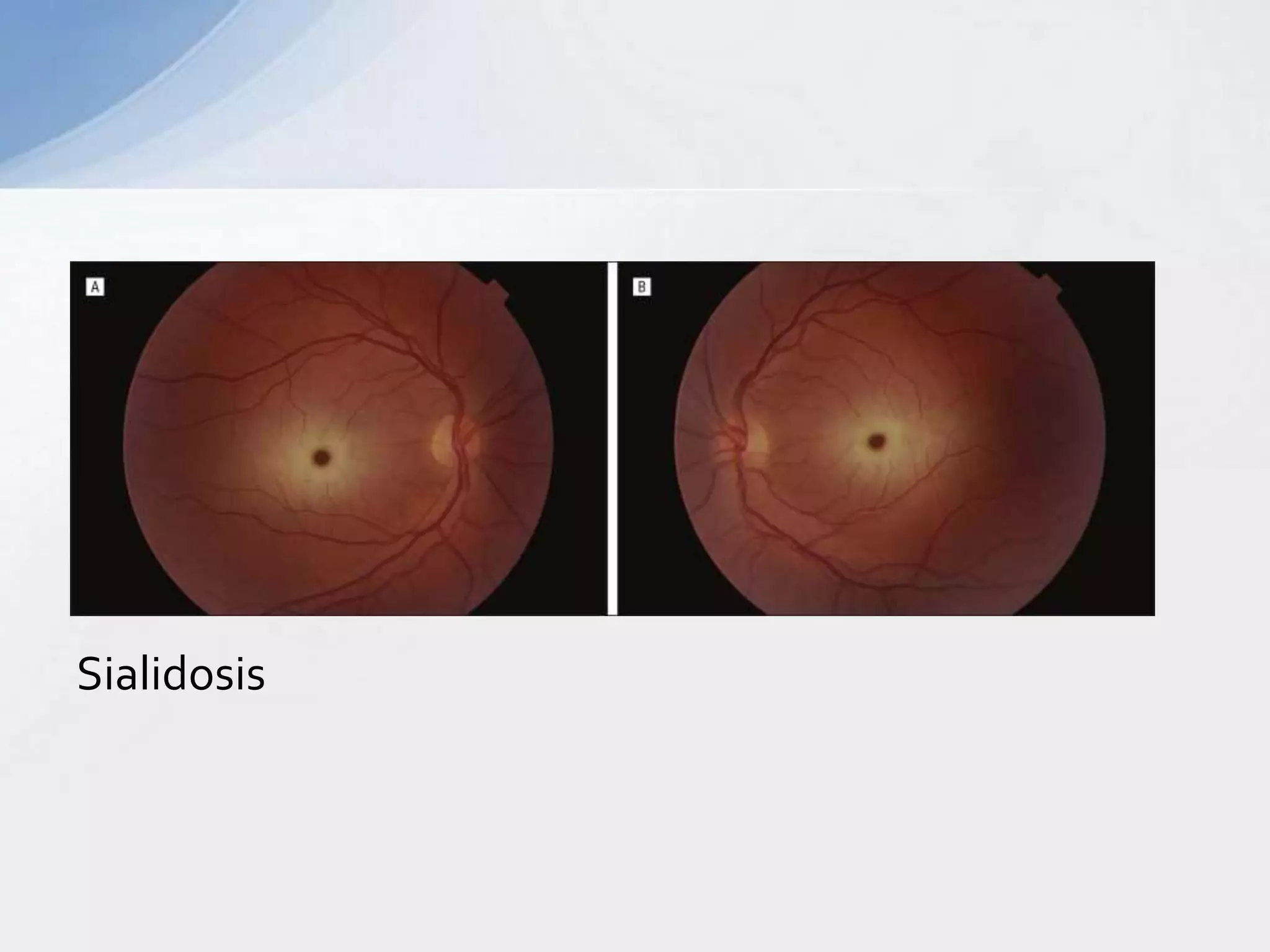 Approach to leukodystrophy | PPTX