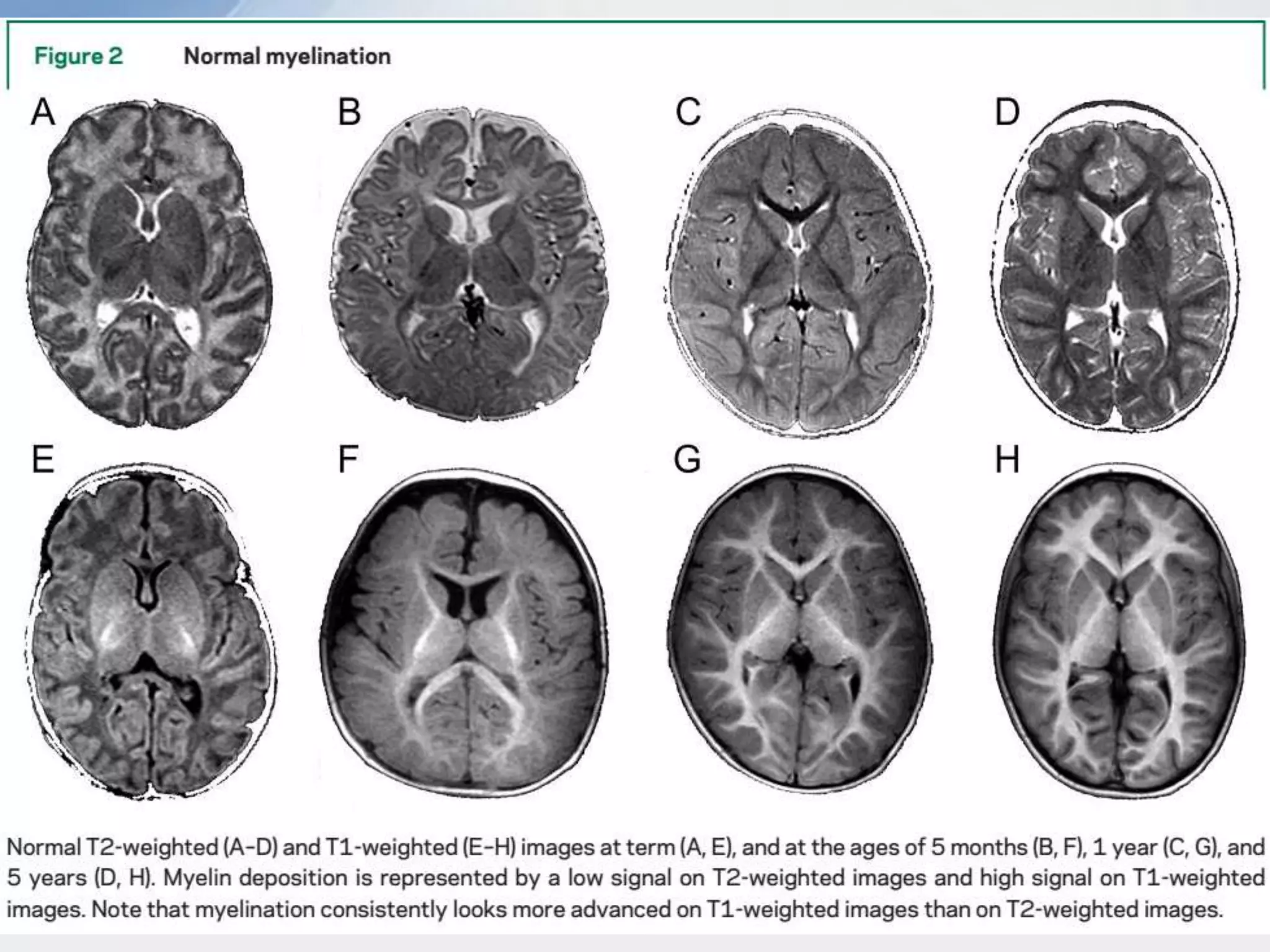 Approach to leukodystrophy | PPTX