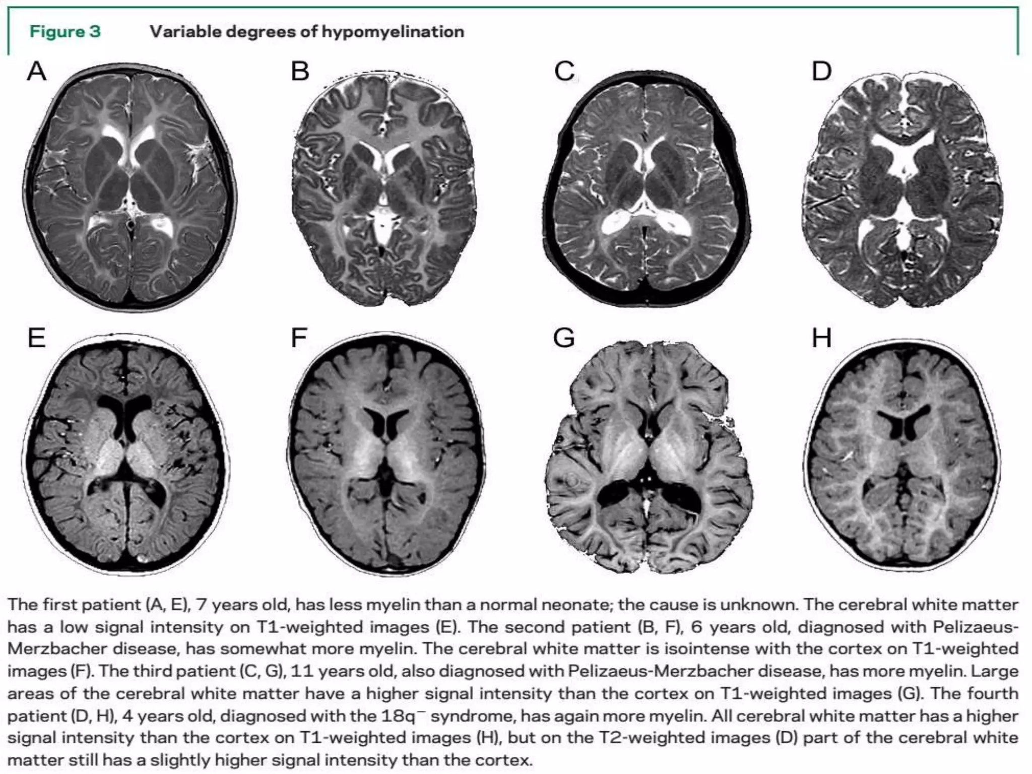 Approach to leukodystrophy | PPTX
