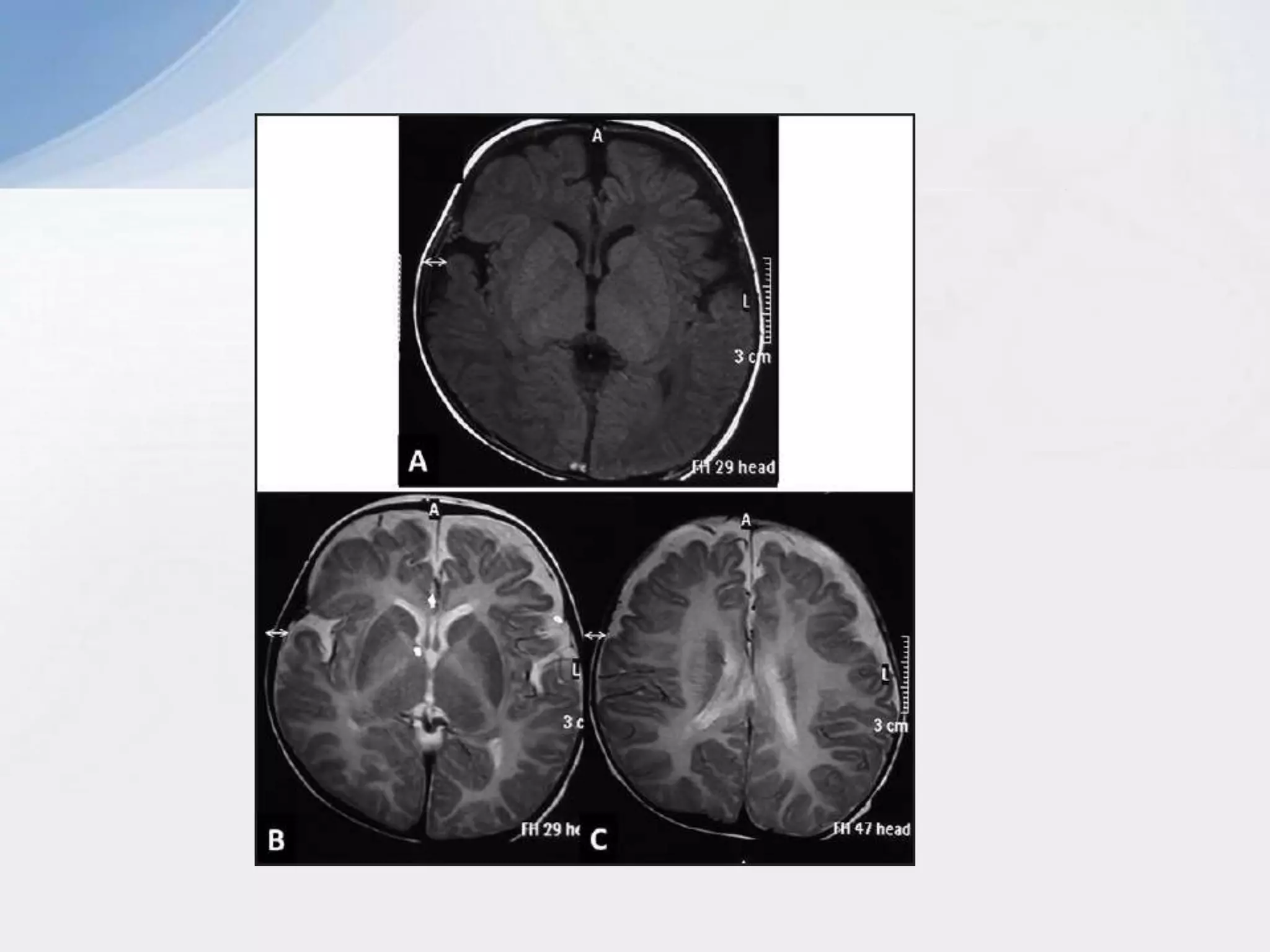 Approach to leukodystrophy | PPTX