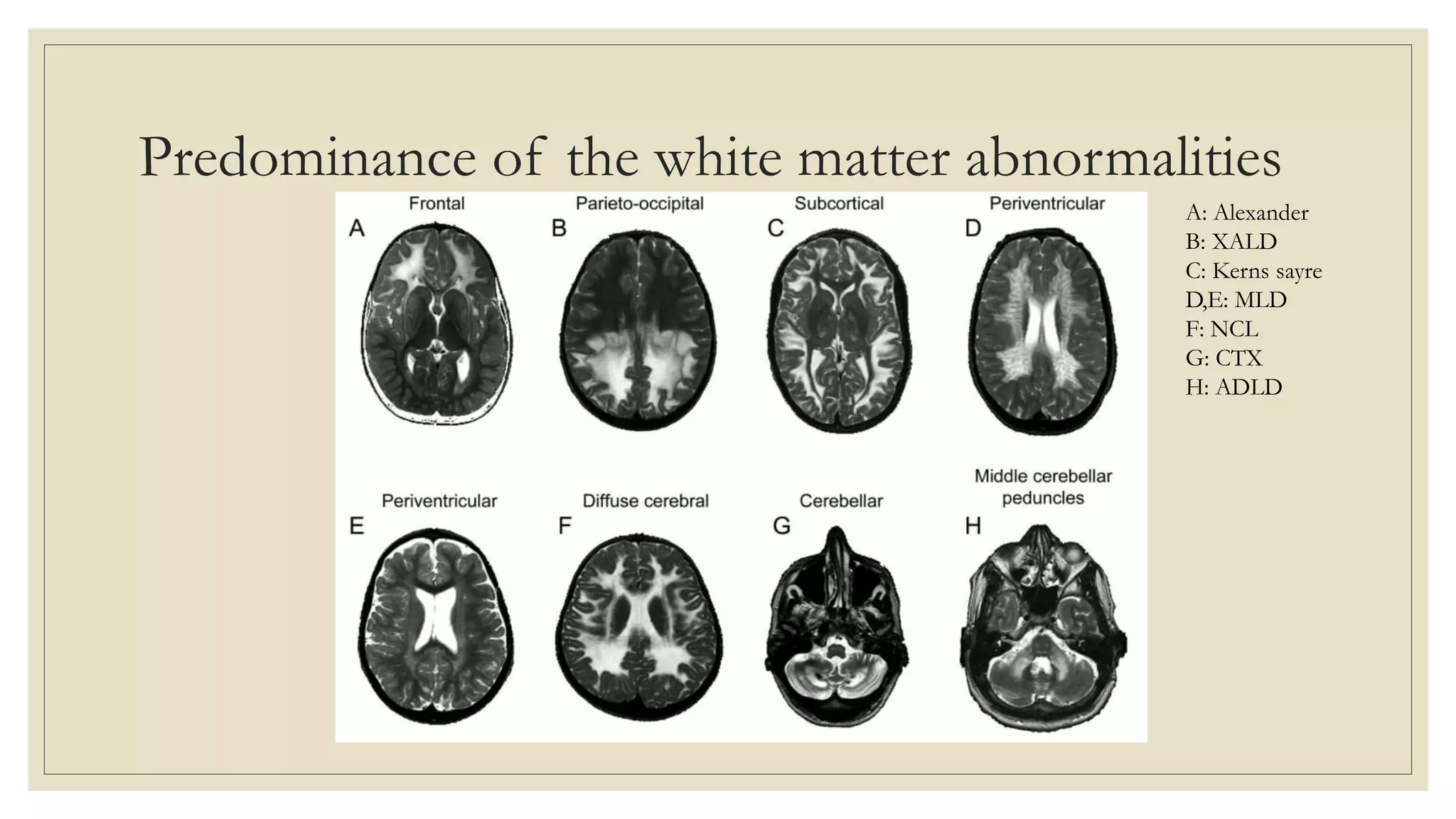 Approach to Leukodystrophy | PPTX