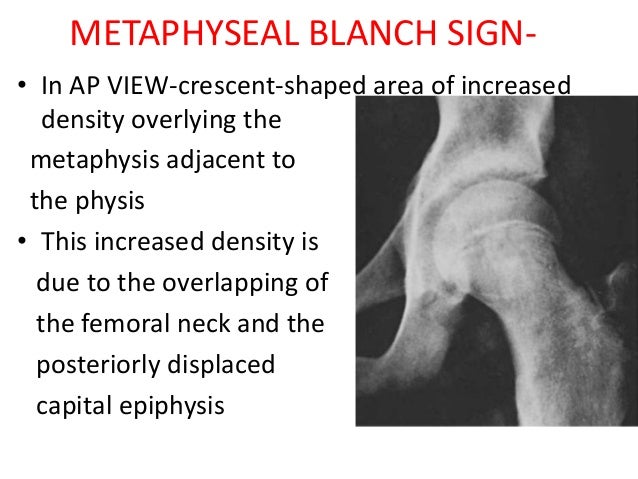 Approach to limping child