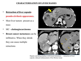approach to liver tumors CT.pptx........ | PPTX