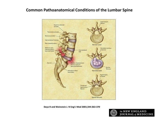 Approach to low back pain | PPTX | Physical Therapy | Wellness