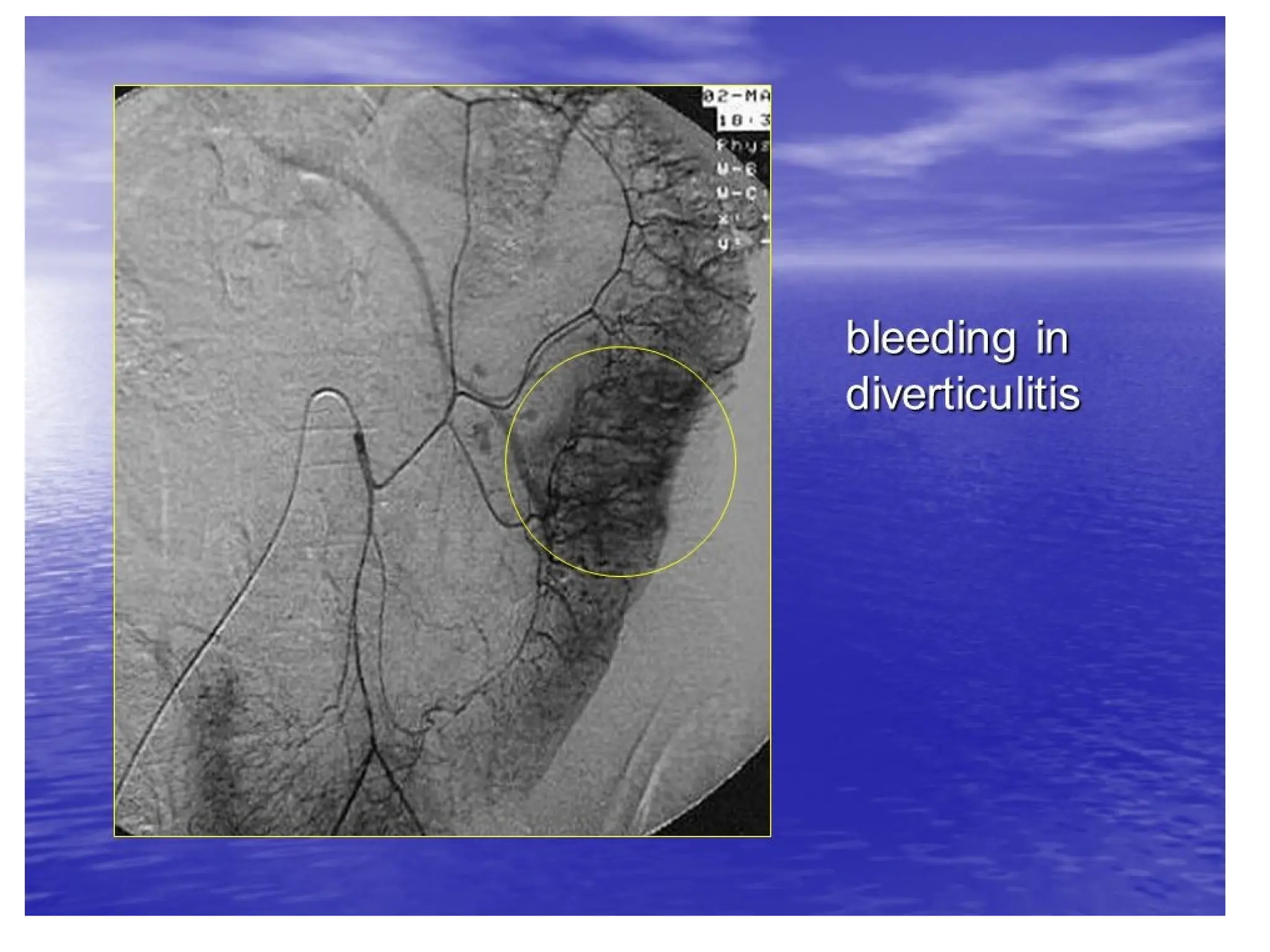 APPROACH TO LOWER GI TRACT BLEEDING.pptx