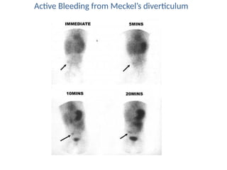 APPROACH TO LOWER GI TRACT BLEEDING.pptx