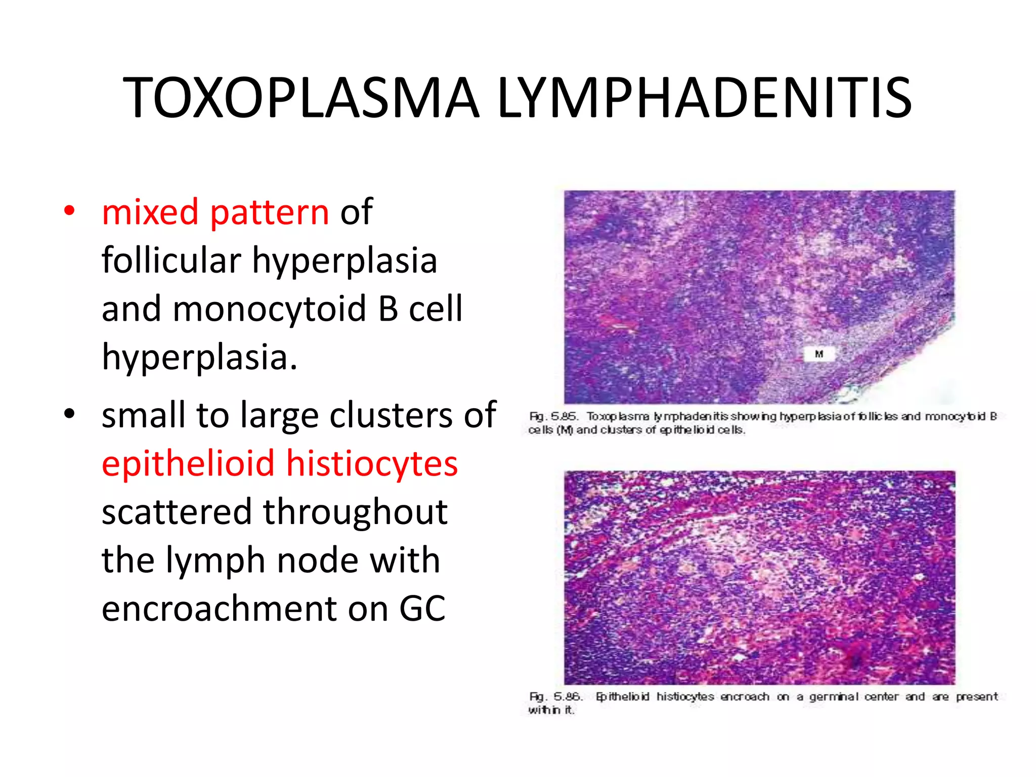 Approach to lymphnode pathology | PPTX | Infectious Diseases | Diseases ...