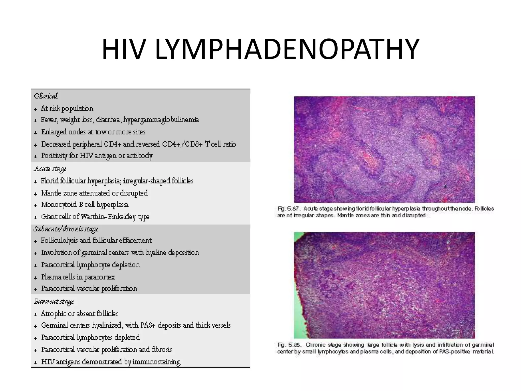 Approach to lymphnode pathology | PPTX | Infectious Diseases | Diseases ...