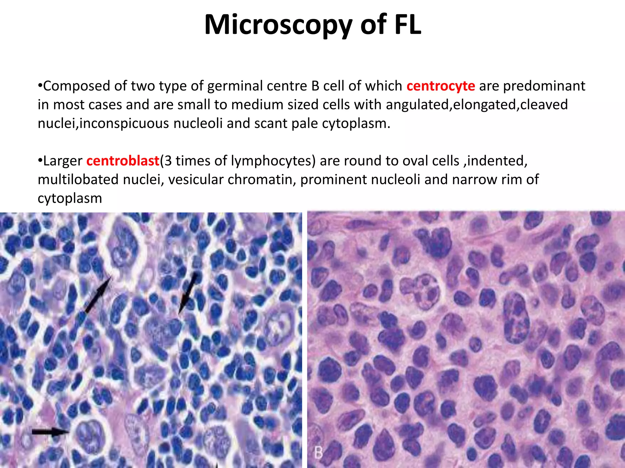 Approach to lymphoma | PPTX