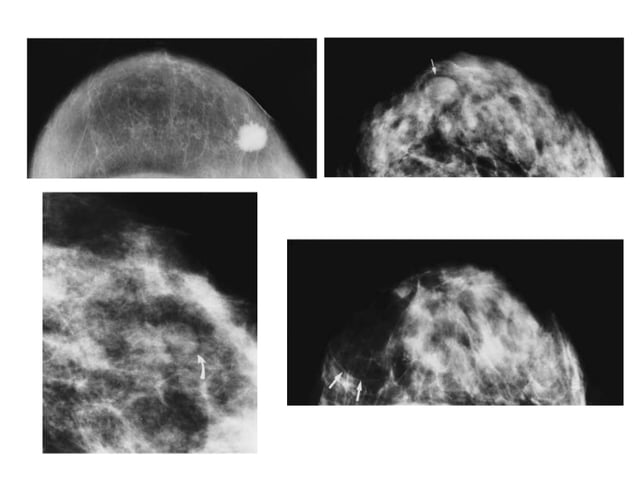 Approach to mammogram | PPTX