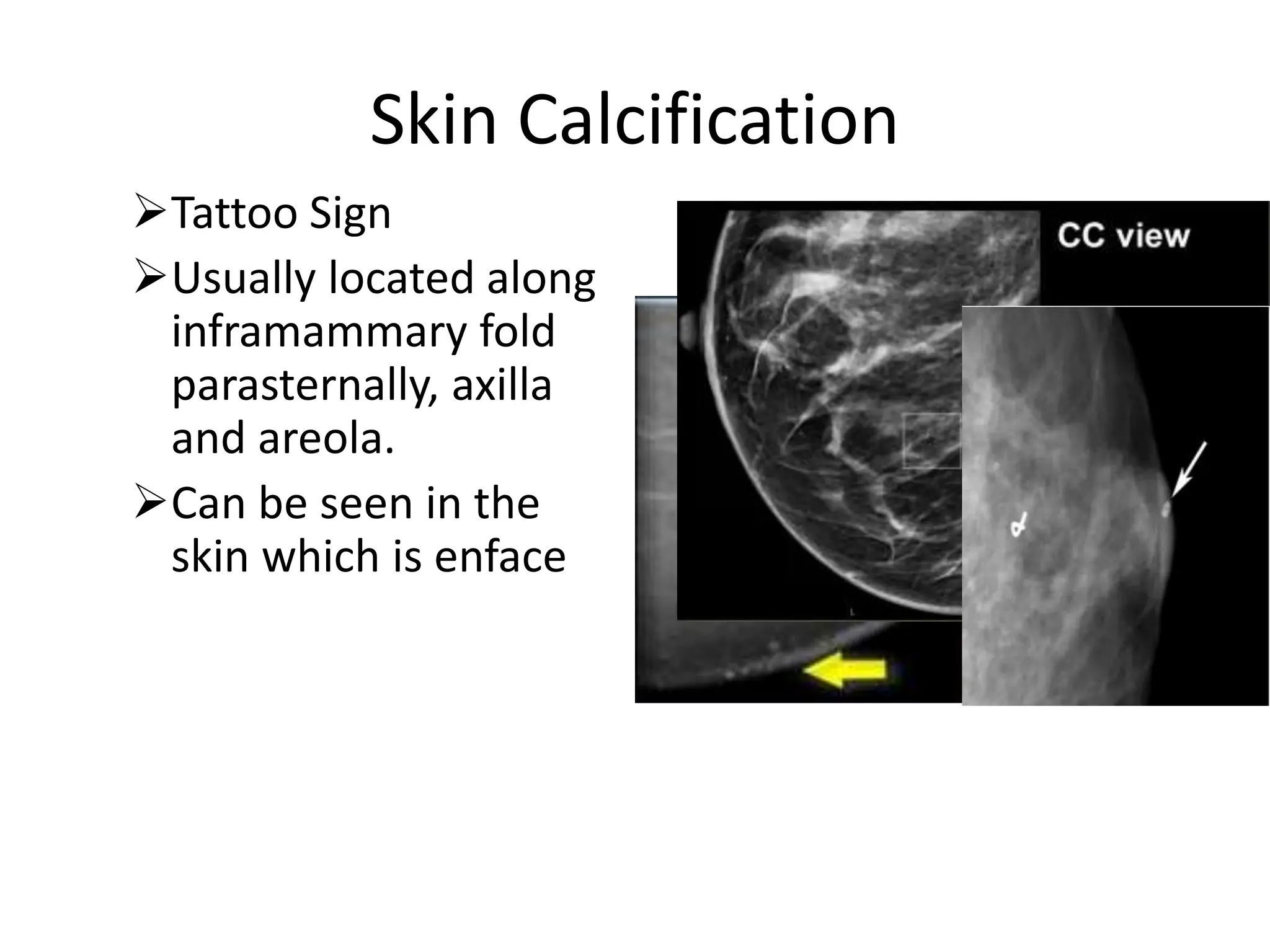 approach to mammogram.ppt