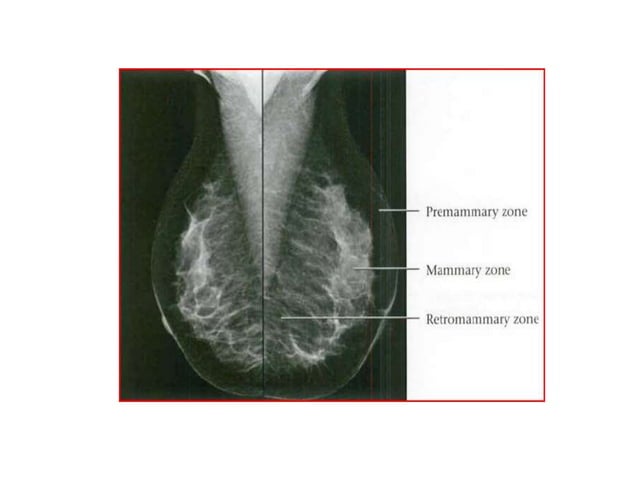 approach to mammogram.ppt