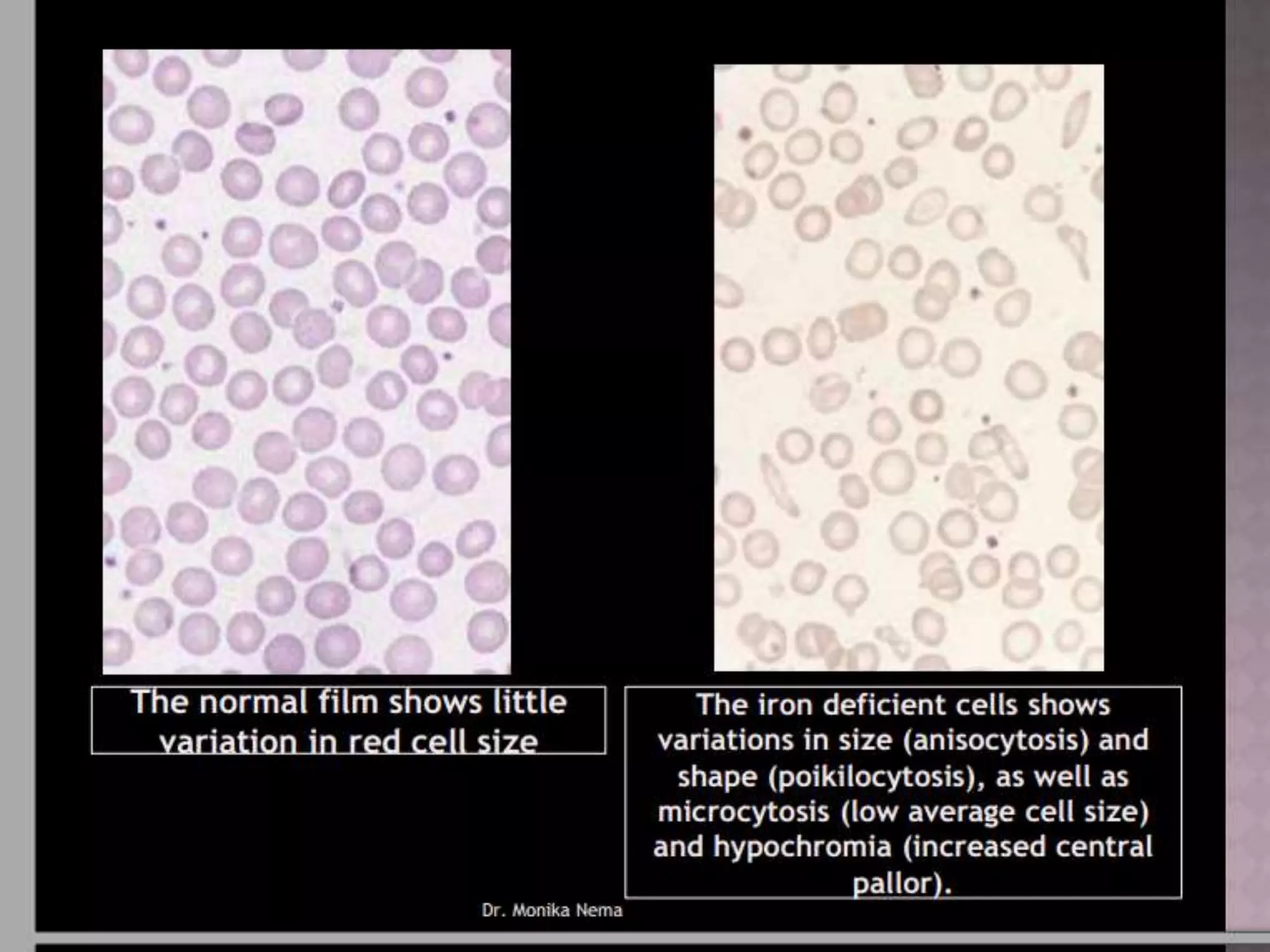 Approach to microcytic hypochromic anemia | PPTX