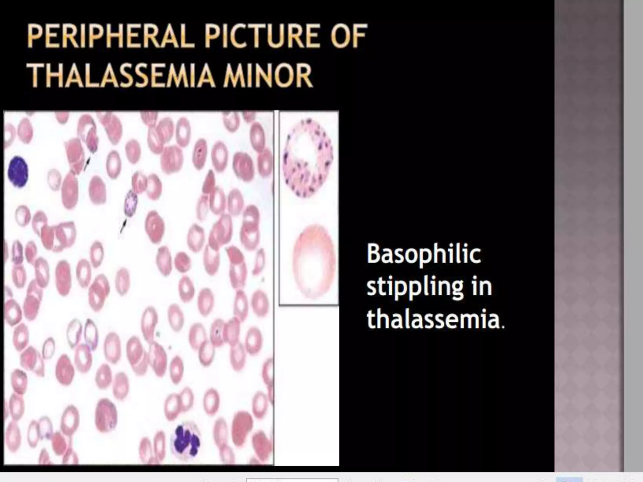 Approach to microcytic hypochromic anemia | PPTX
