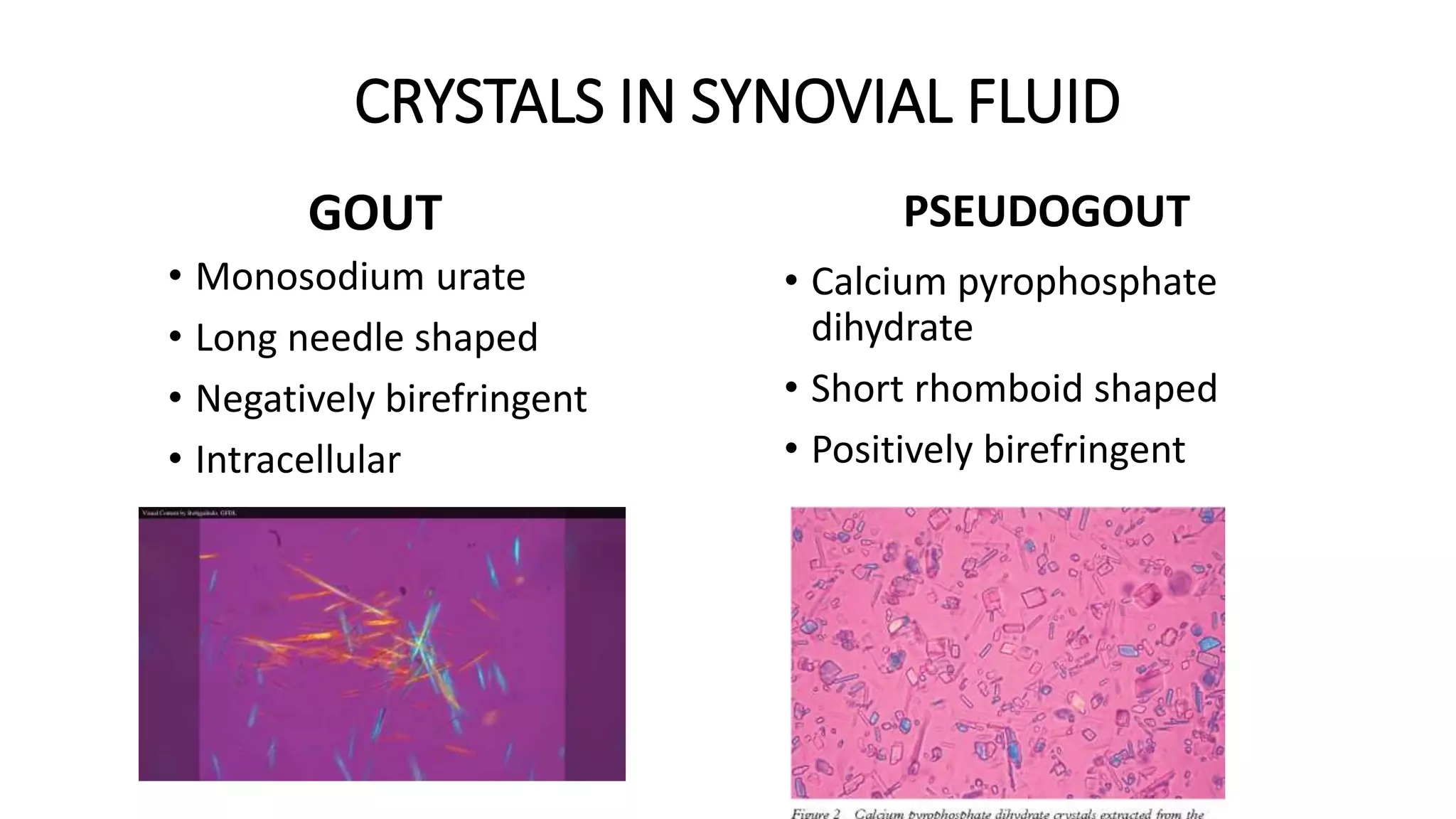 Approach to monoarthritis | PPTX