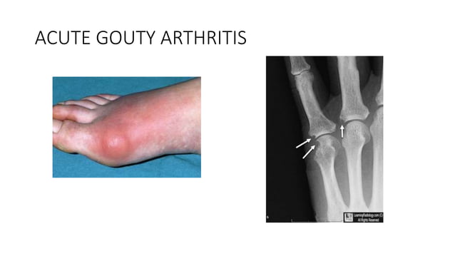 Approach to monoarthritis | PPTX
