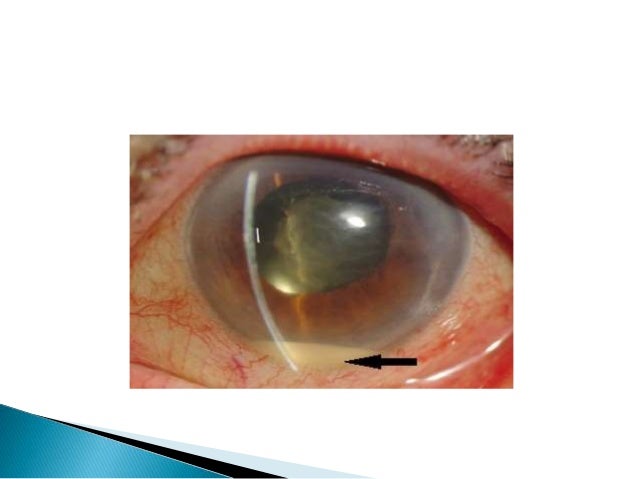 Approach to monocular blindness