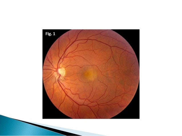 Approach to monocular blindness