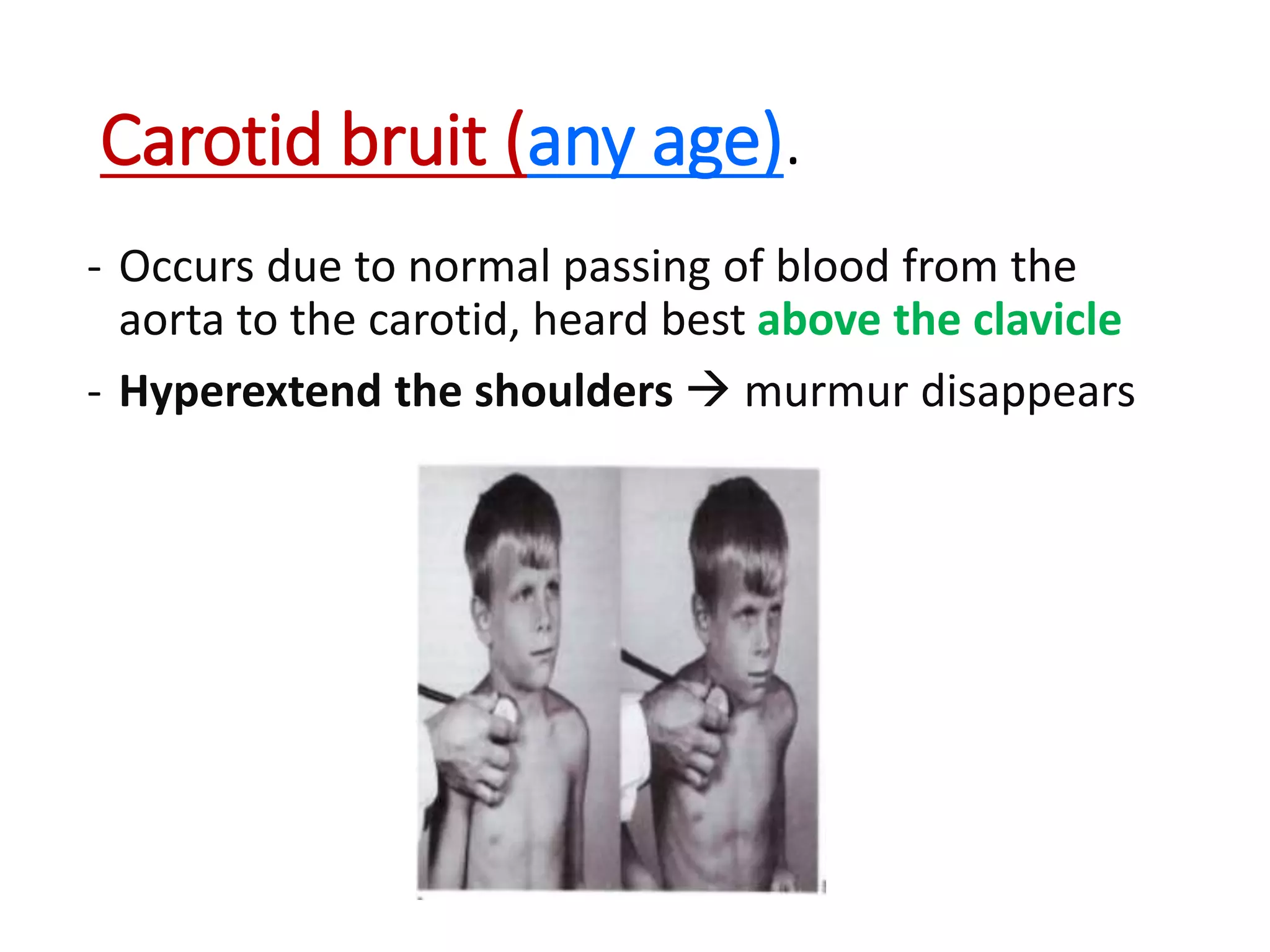 Approach to murmur in Paediatrics.pptx