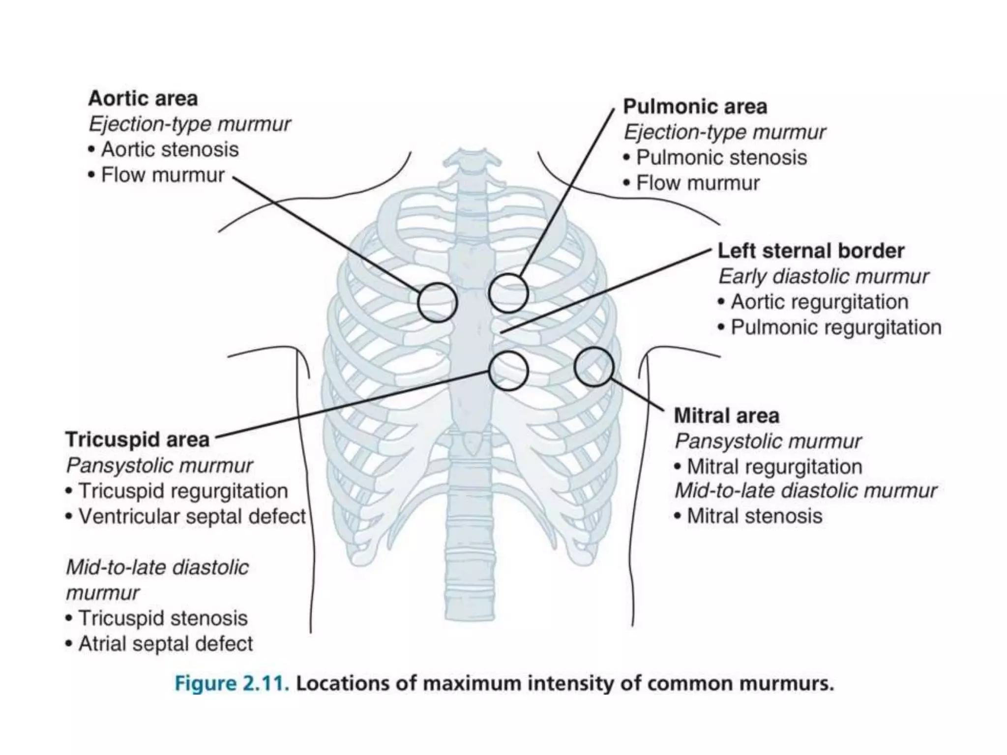 Approach to murmur in Paediatrics.pptx