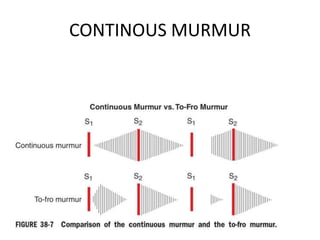 Approach to Heart Murmurs | PPTX