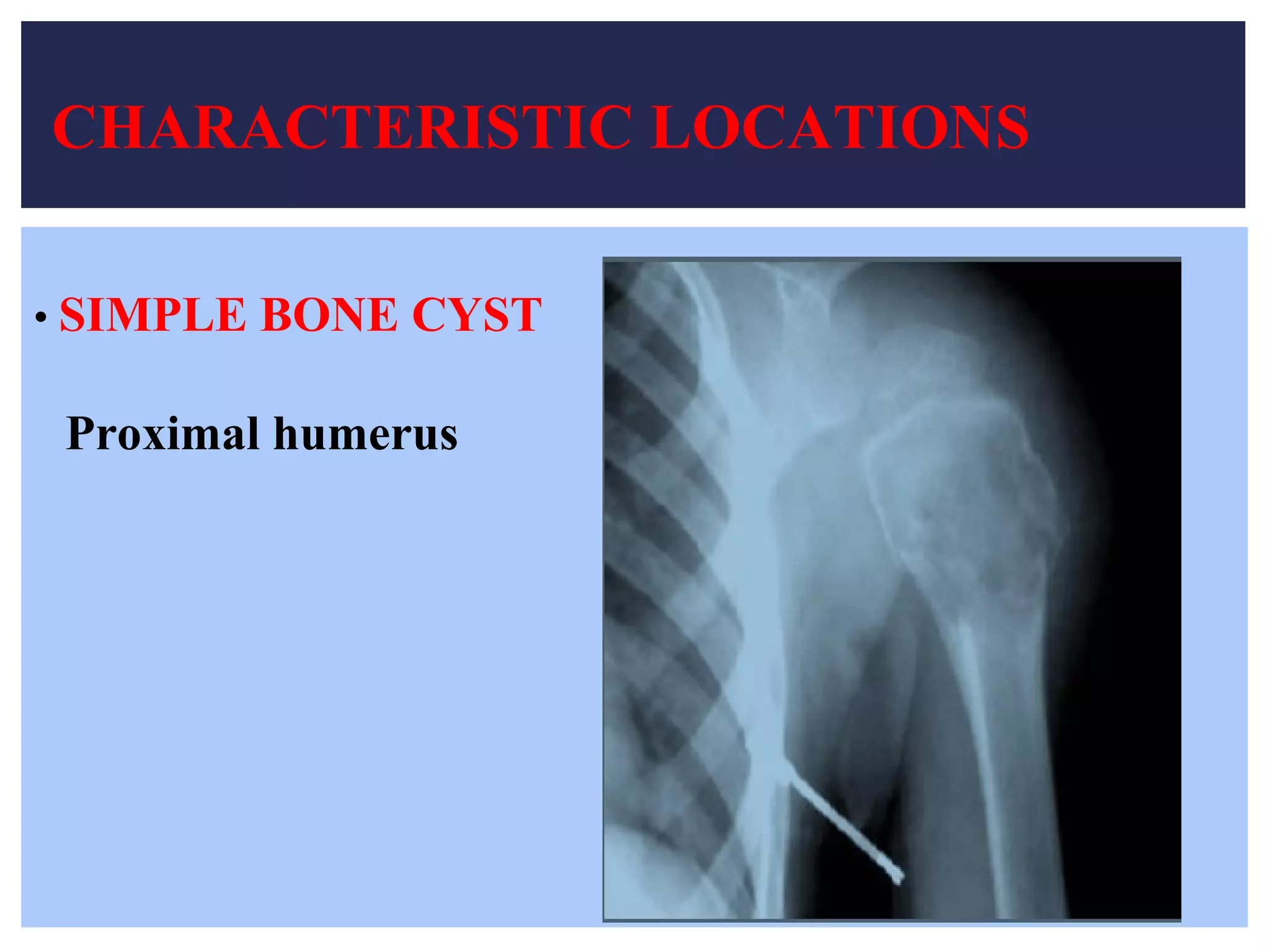Approach to musculoskeletal neoplasms | PPT