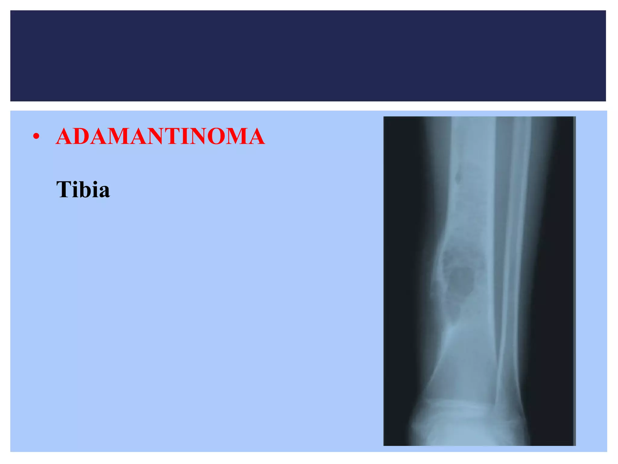 Approach to musculoskeletal neoplasms | PPT