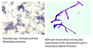 approach to mycetoma.pptx