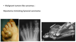 approach to mycetoma.pptx