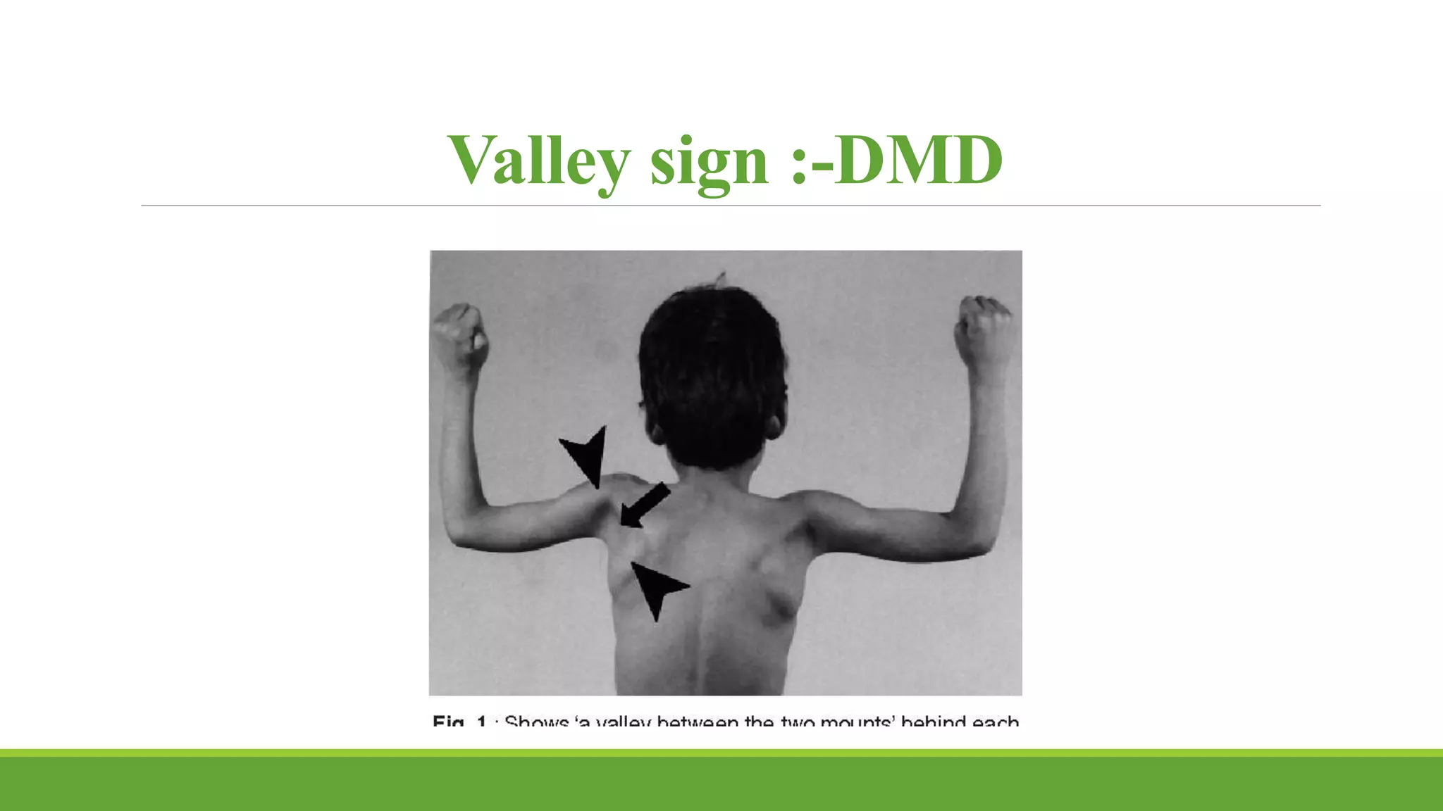 Approach to myopathy | PPTX