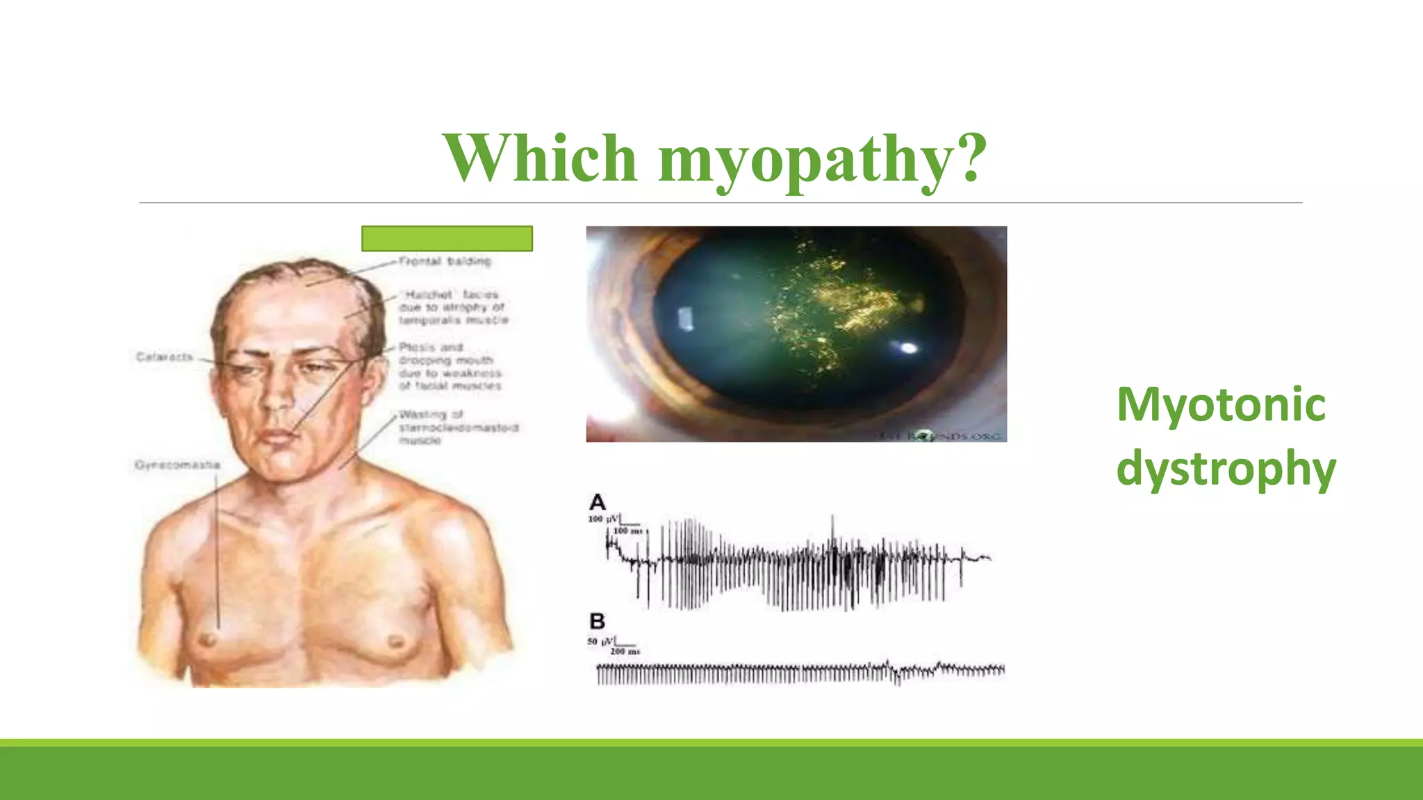 Approach to myopathy | PPTX
